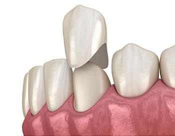 Esthetic Crown Lengthening Pittsburgh PA, Martin L. Supowitz, DMD, MSD